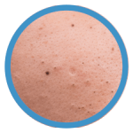 Acne Treatment - The Womens Health Clinic