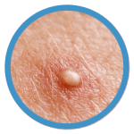 Acne Treatment - The Womens Health Clinic